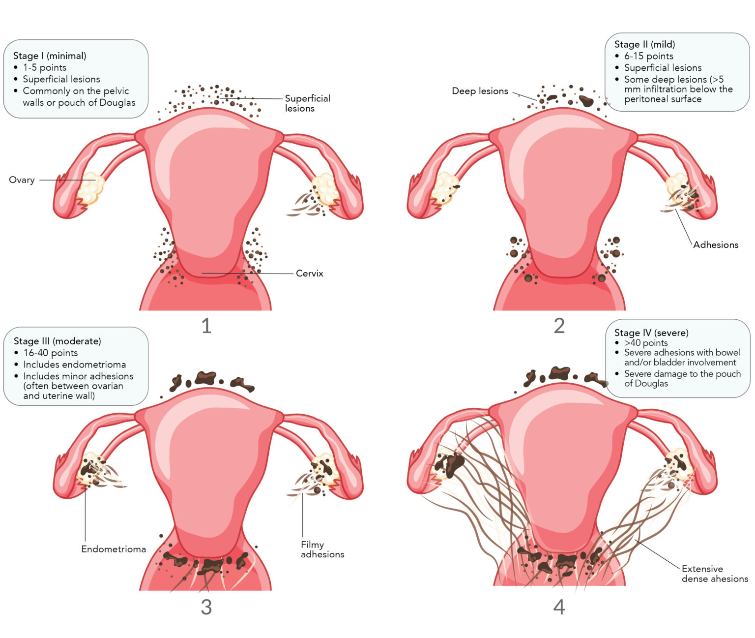 Endometriosis: Subtypes, Symptoms, and Patient Impact - Pelvic Pain ...